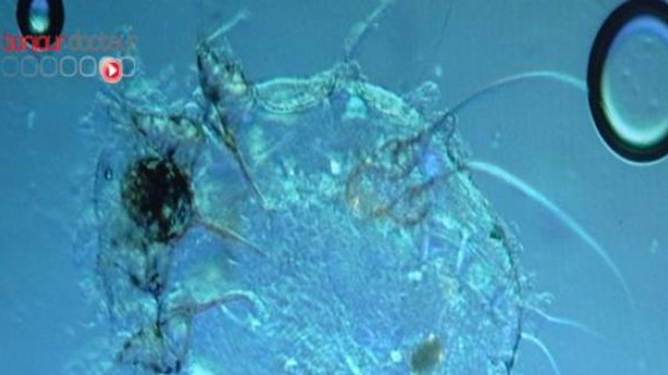 Recrudescence de la gale : quels signes doivent alerter ? - AlloDocteurs