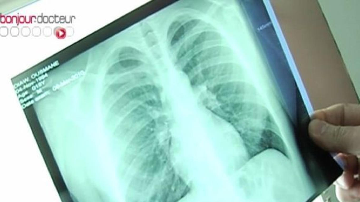 Vers un test respiratoire de la tuberculose ? - AlloDocteurs