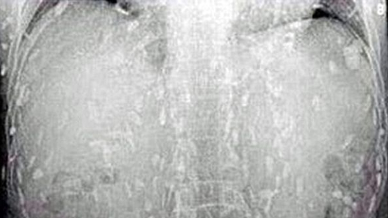 Vers intestinaux - AlloDocteurs