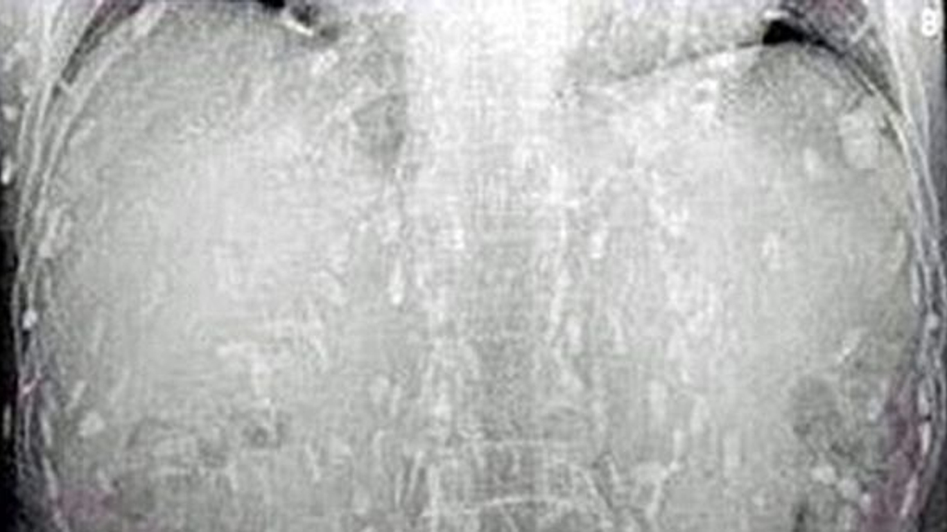 Le corps infesté de vers après avoir consommé du poisson cru ...