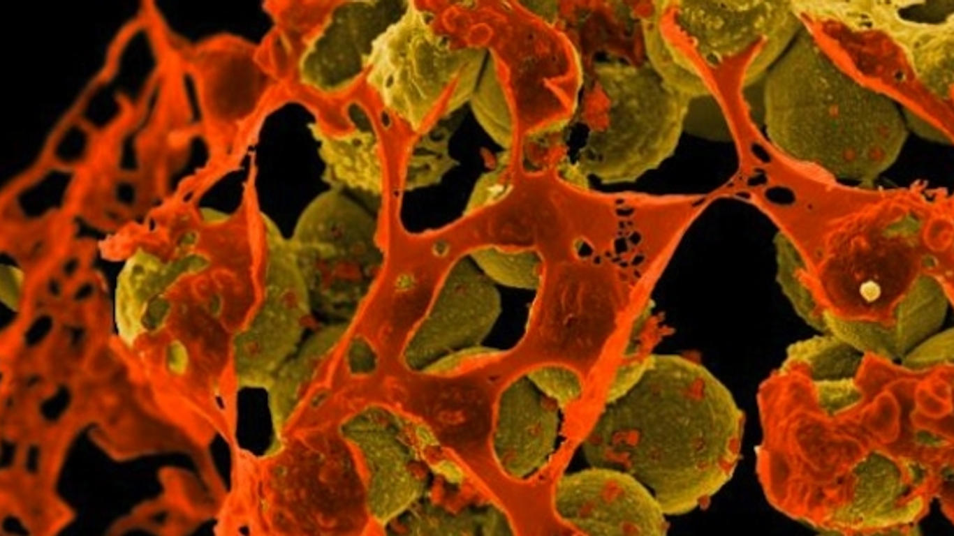 Eczéma : le staphylocoque doré impliqué dans le déclenchement de la ...