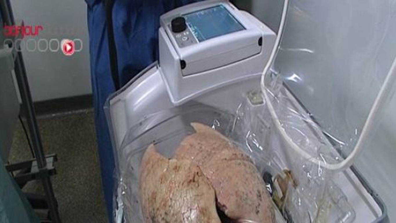 Greffe : la conservation des organes à transplanter - AlloDocteurs