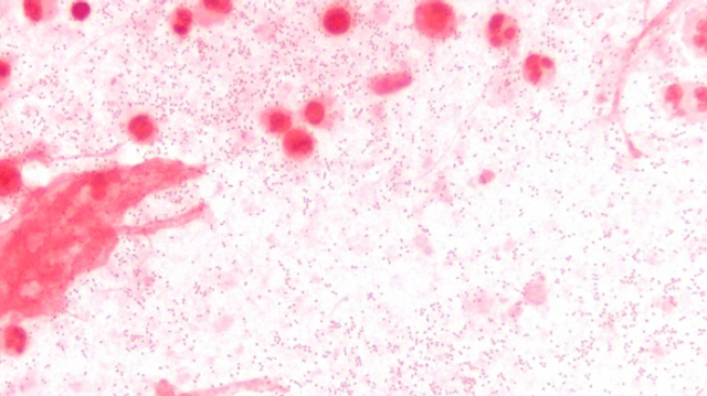 Méningite bactérienne : une infection mal connue et pourtant très ...