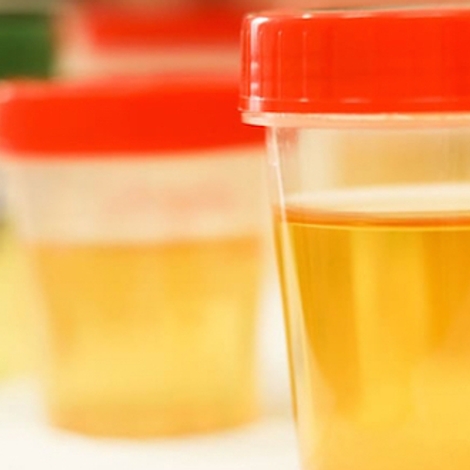 Que signifie avoir des hématies dans les urines ? - AlloDocteurs