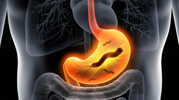 Ulcère digestif gastro-duodénal - AlloDocteurs