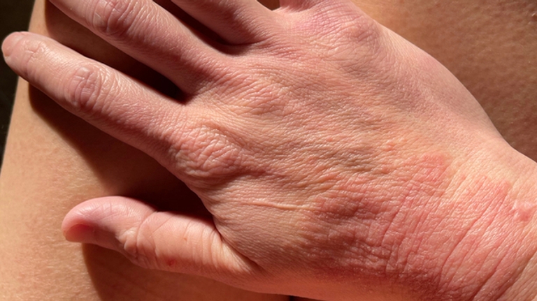 Cortisone - AlloDocteurs