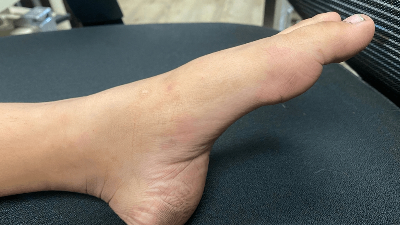 Quels sont les premiers symptômes de la maladie de Charcot ? - AlloDocteurs