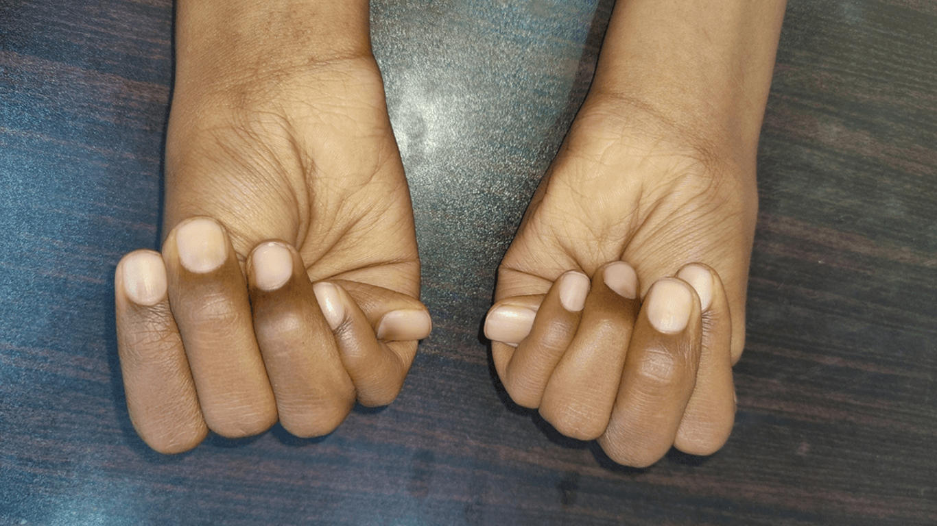 Test du pouce et risque d'anévrisme : vrai ou fake ? - AlloDocteurs