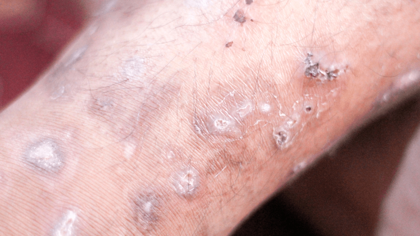 La gale, une maladie très contagieuse - AlloDocteurs