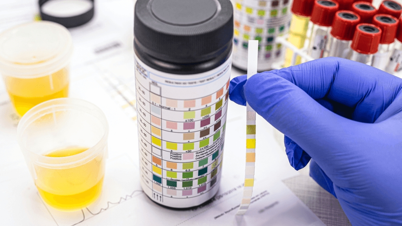 Analyse des urines : on vous aide à comprendre les résultats de votre ...