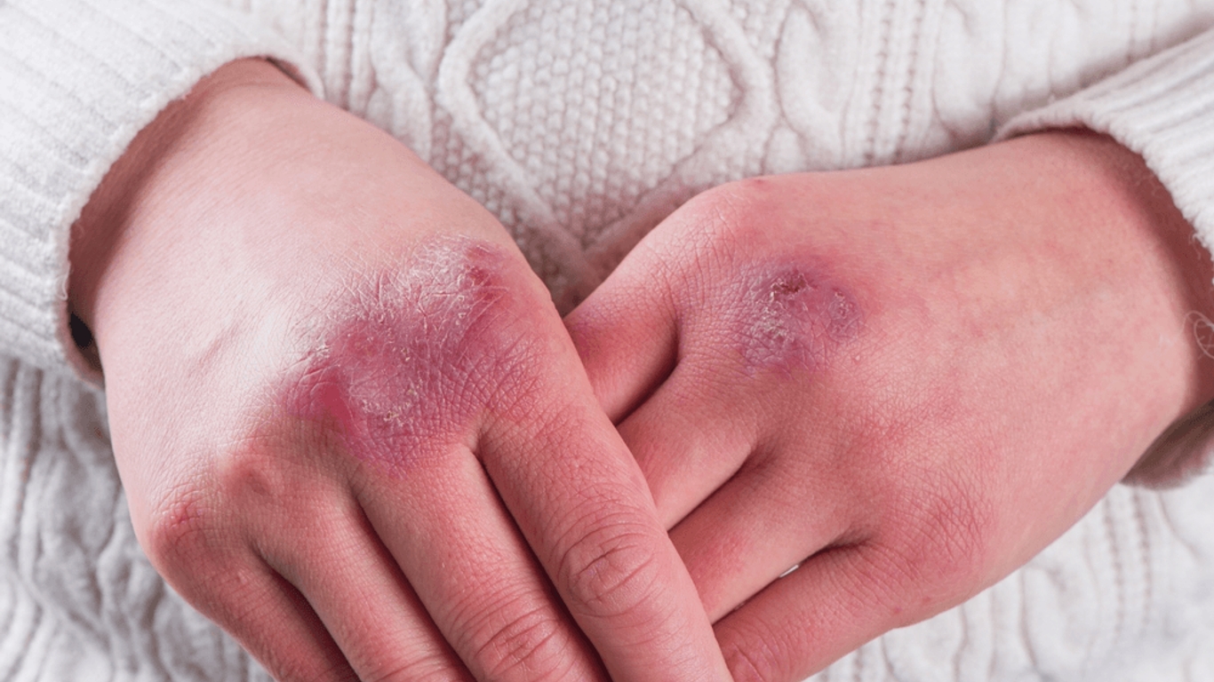 Comment se débarrasser des engelures ? - AlloDocteurs