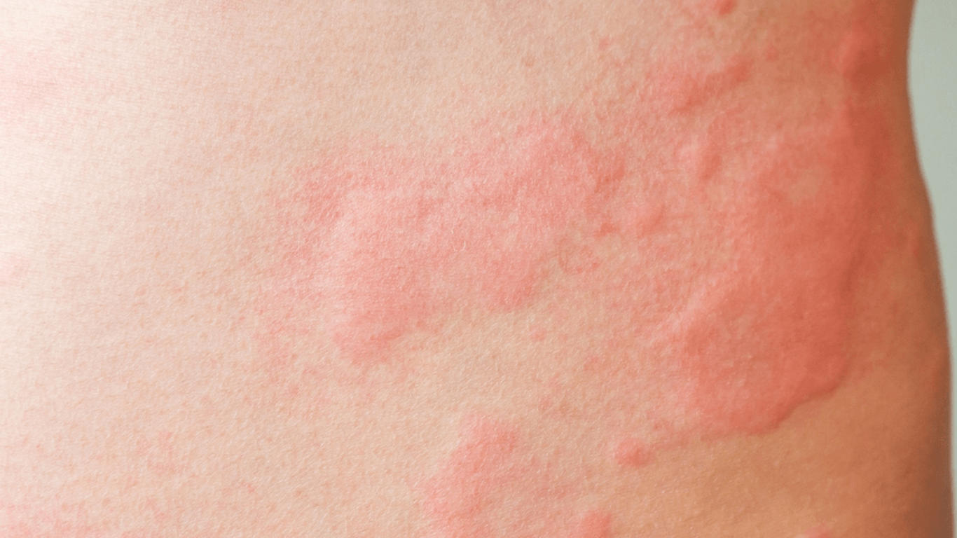 Urticaire : une maladie qui peut gâcher la vie - AlloDocteurs