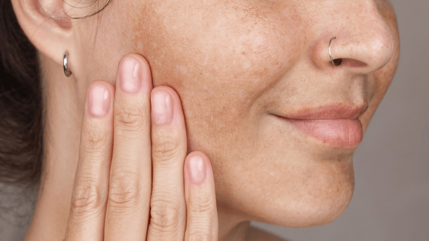 Taches sur la peau : peut-on les faire disparaître ? - AlloDocteurs