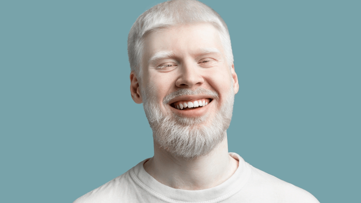 Symptômes, traitement, conséquences... Tout savoir sur l'albinisme - AlloDocteurs