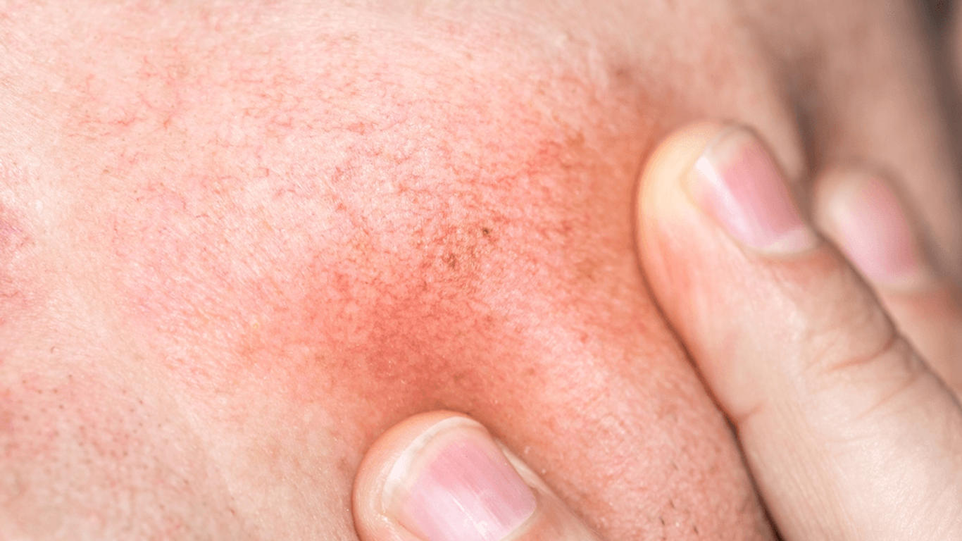 J'ai des tâches rouges après l'effort : faut-il s'inquiéter ...