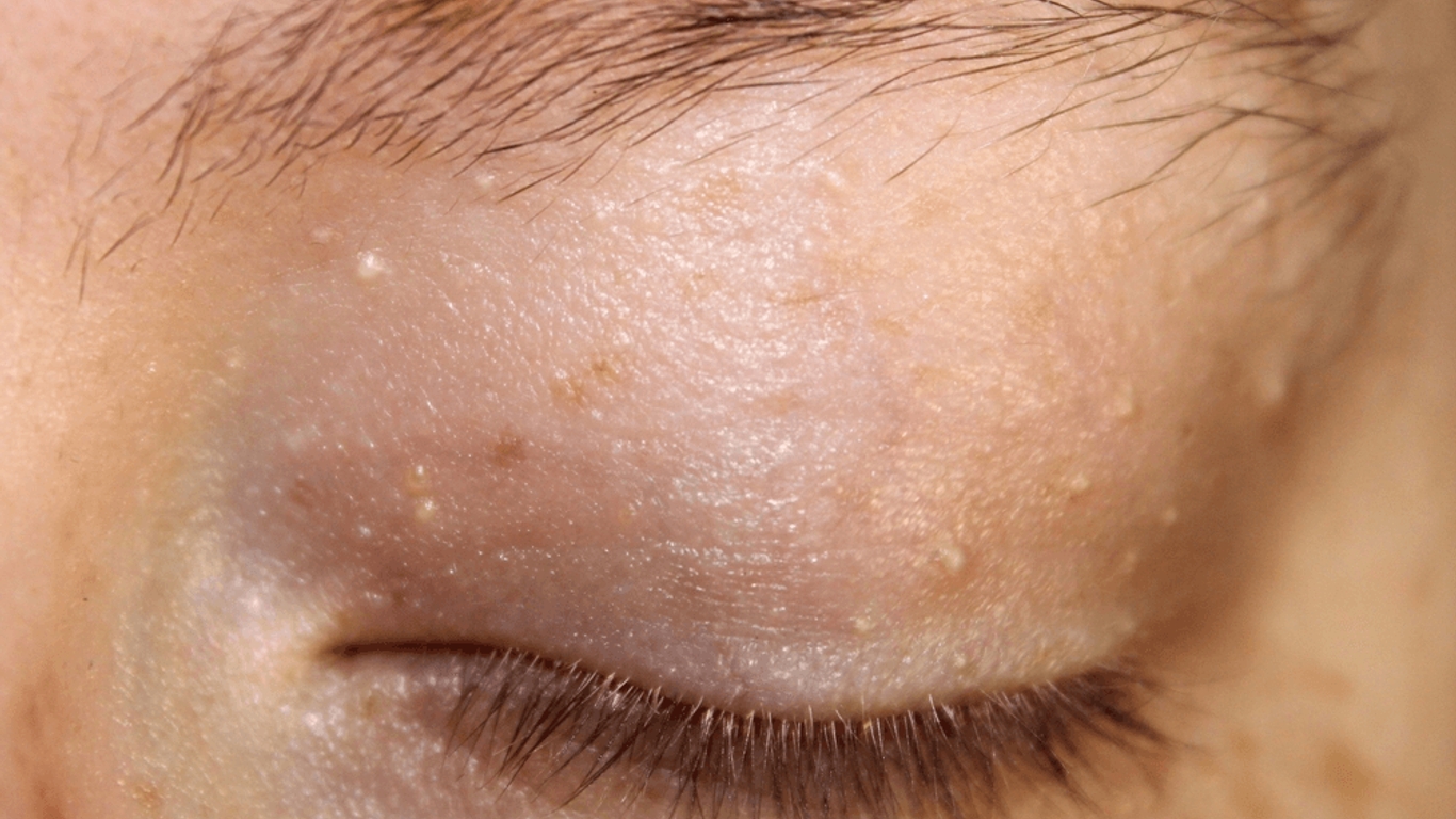 Comment faire disparaître les grains de milium sur la peau - AlloDocteurs