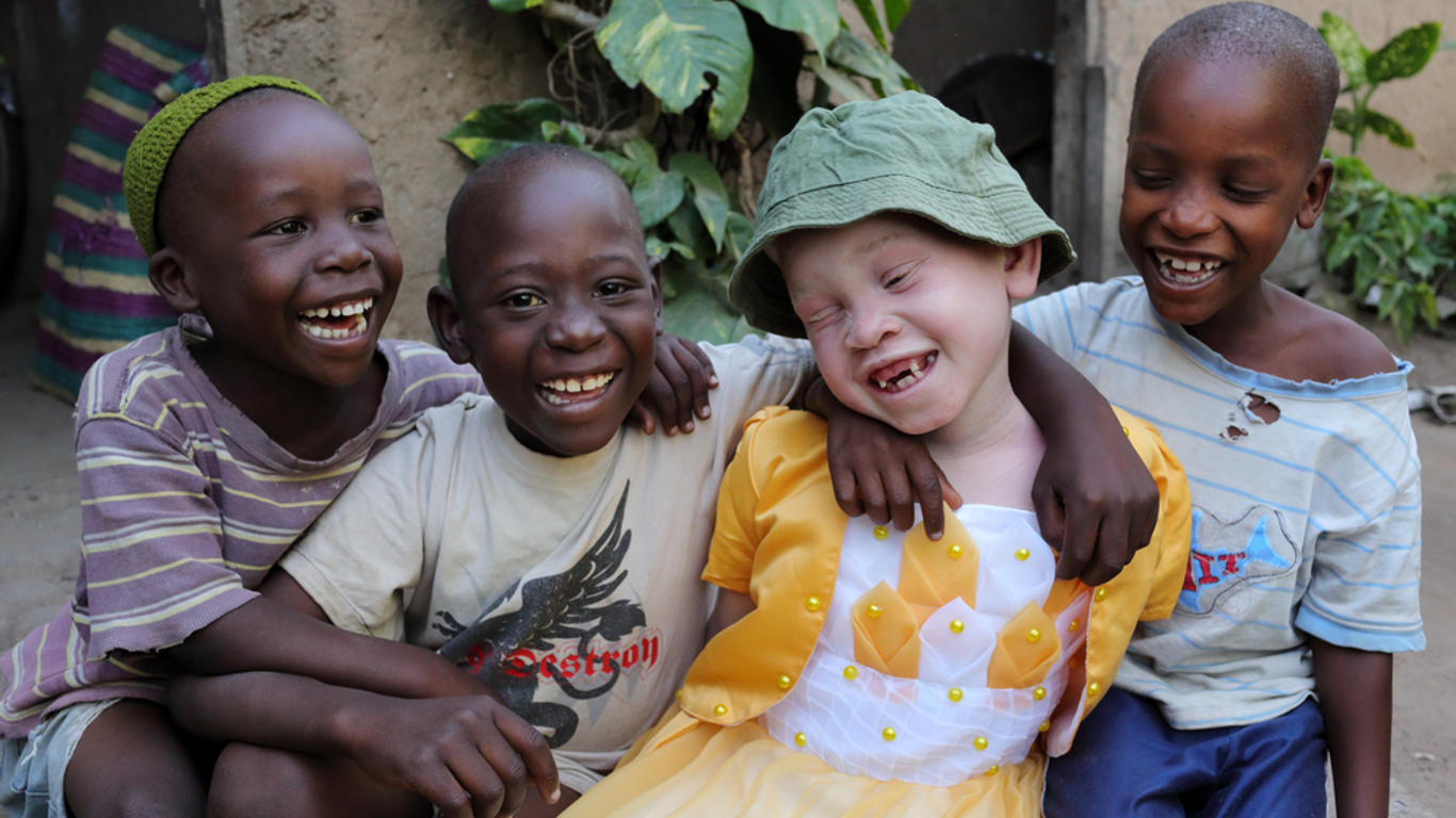 Nos conseils pour bien vivre son albinisme - AlloDocteurs