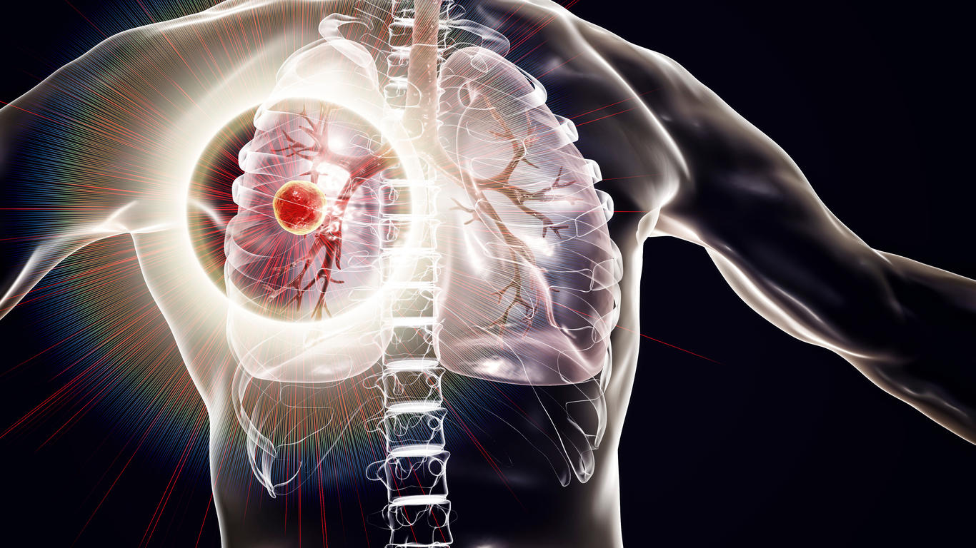 La tuberculose pulmonaire - AlloDocteurs