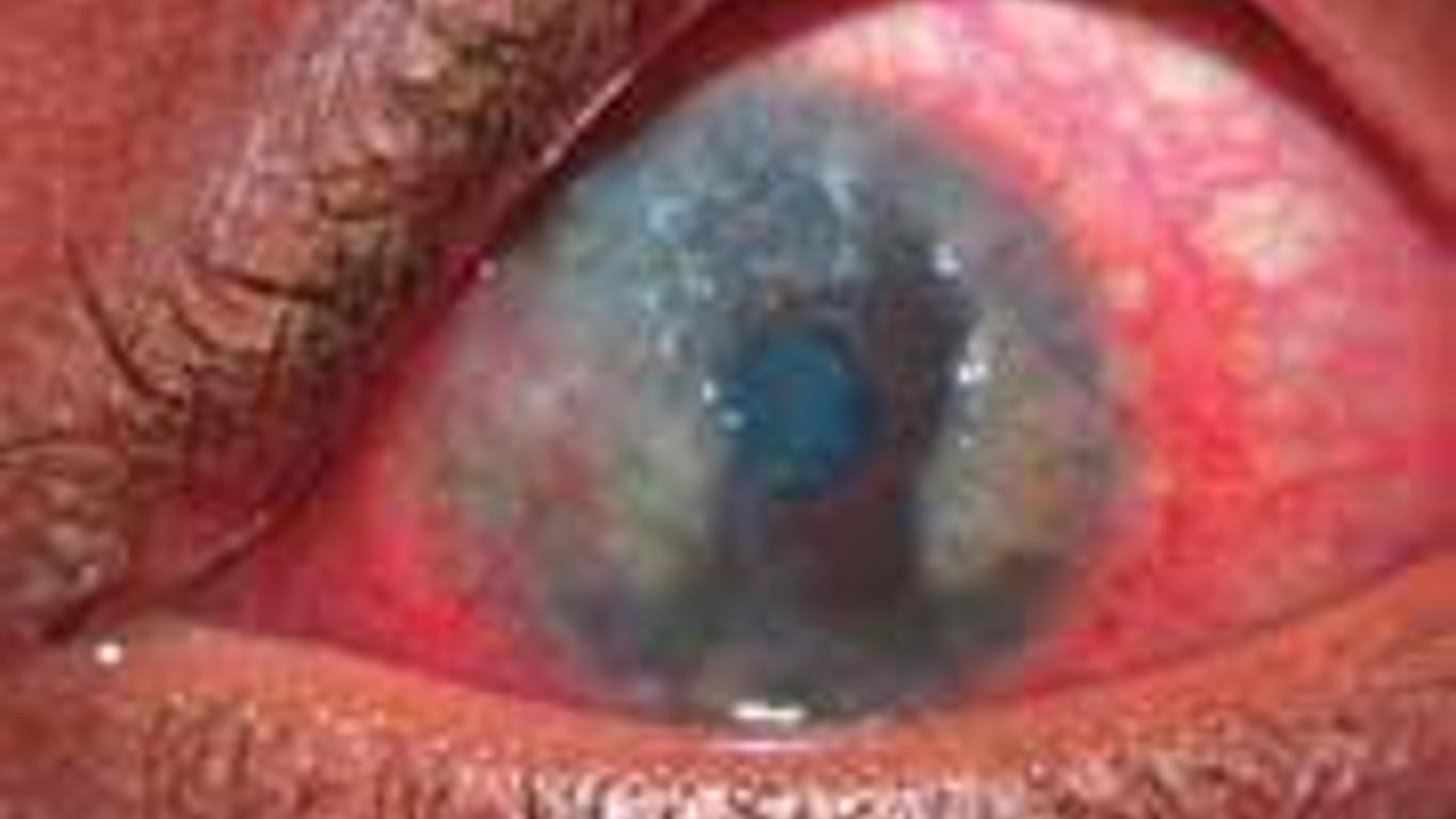 La maladie d'Apollo enflamme les yeux des Nigériens - AlloDocteurs