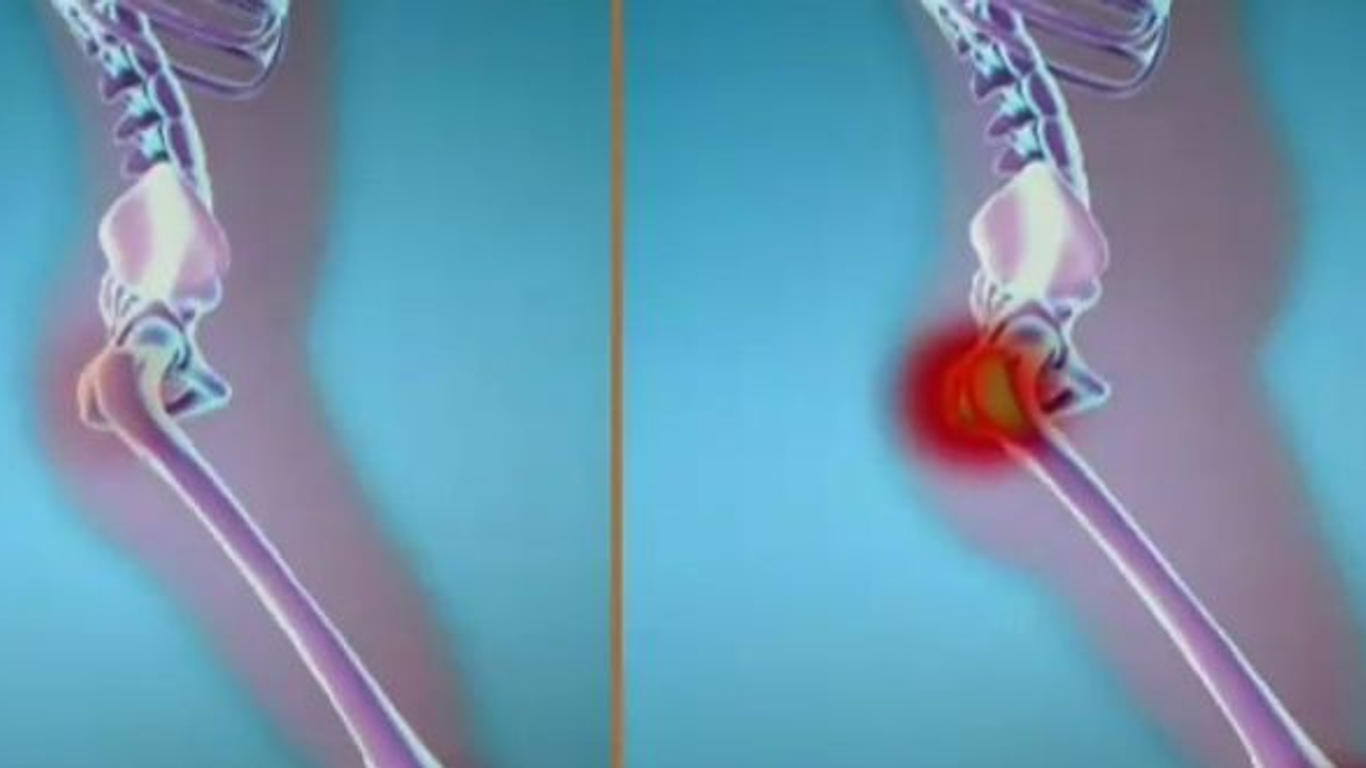 Quelles différences entre l'arthrose et l'arthrite ? - AlloDocteurs