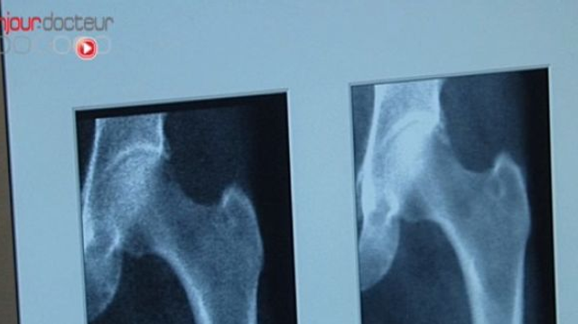 L'ostéoporose, entre méfiance et méconnaissance - AlloDocteurs