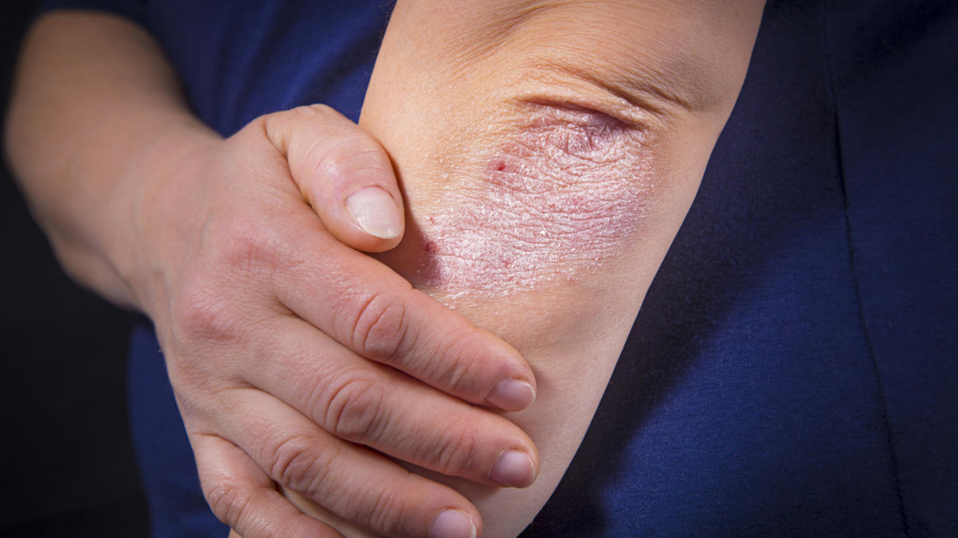 Psoriasis : quels traitements, quels progrès ? - Allo Docteurs